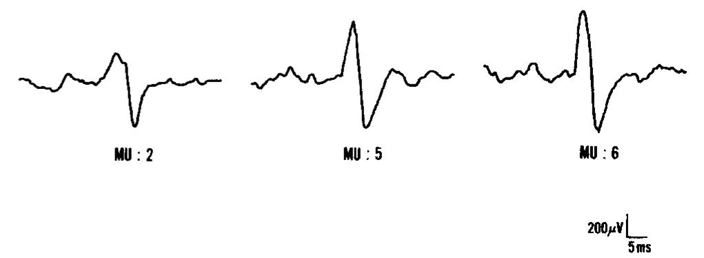 The macro-emg potentials here are triggered and averaged for