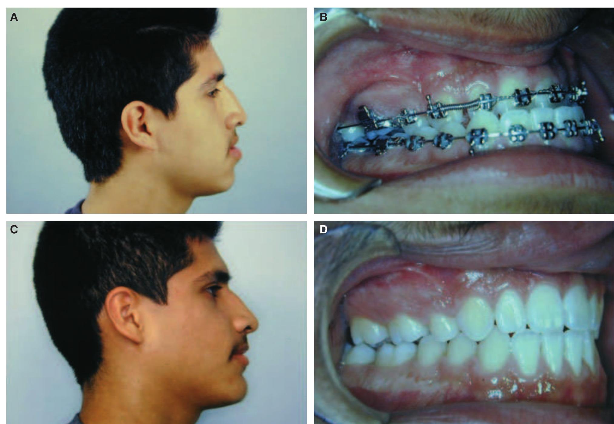 Patient with maxillary hypoplasia, anterior cross bite,