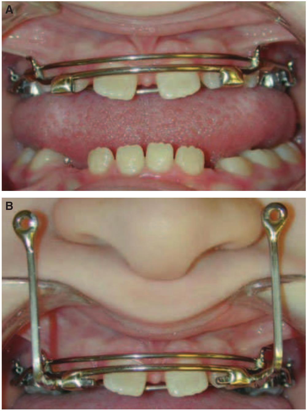 Intra-oral splint with removable external traction hooks
