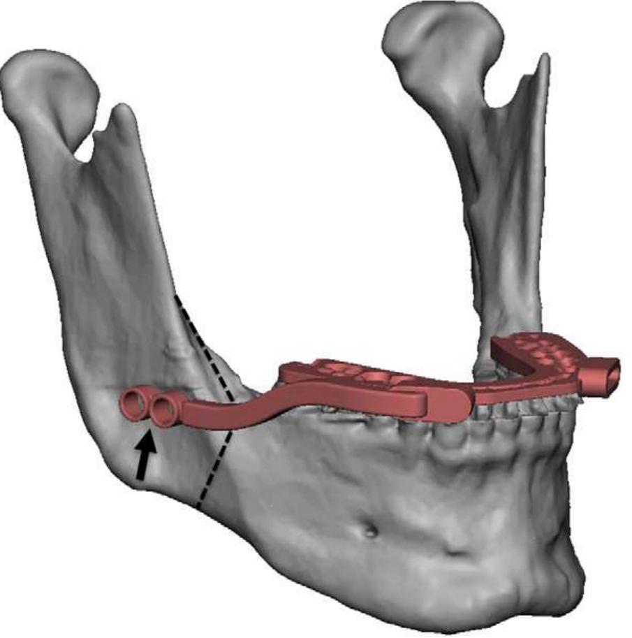 Diagrammatic representation of mandibular drilling guide to