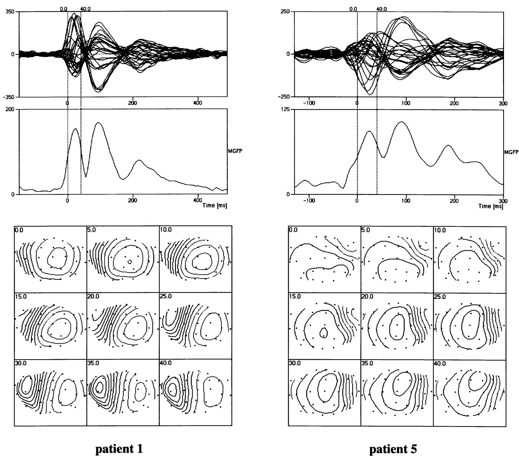 Typical examples of epileptic spike data (spike / wave