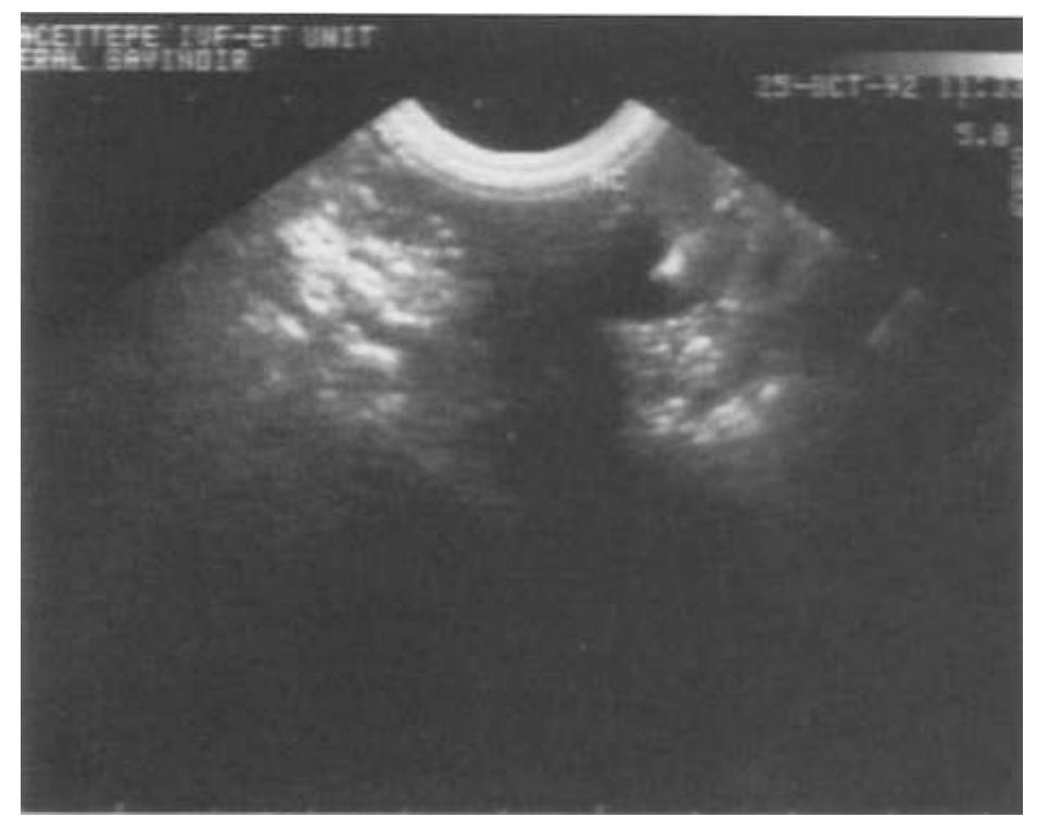 , the aspirating needle is shown in the endocervical cyst