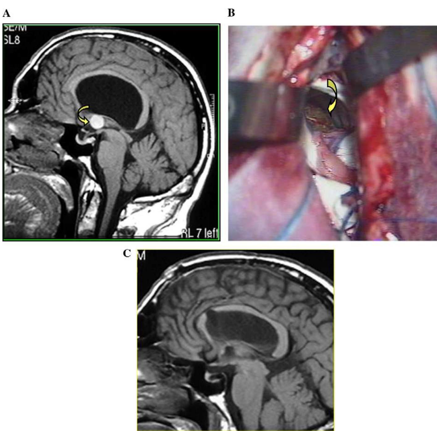 (a) mri sagittal view of a colloid cyst of the third