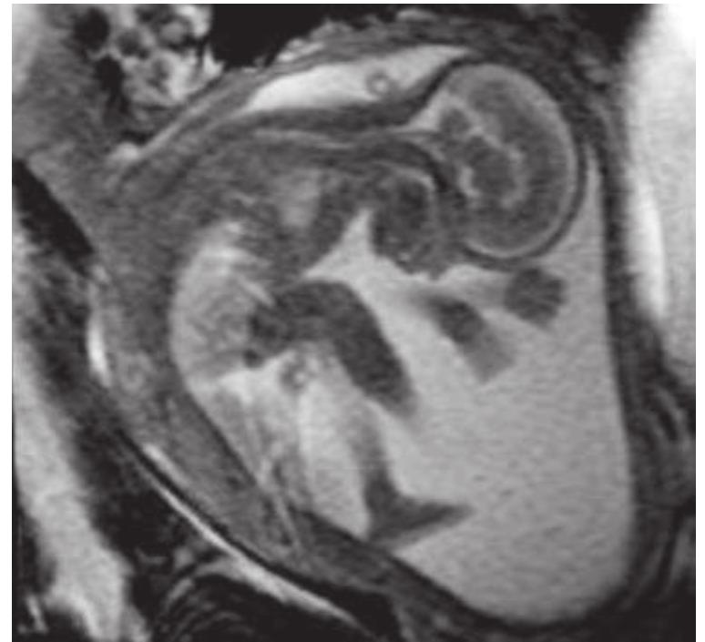Fetal mr imaging with a fiesta sequence. static image shows