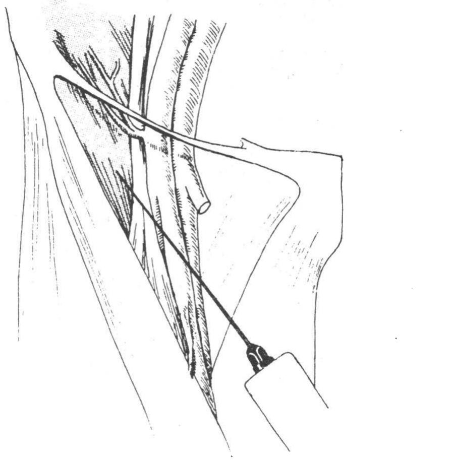 The anatomy of the iliopsoas muscle in the region of the