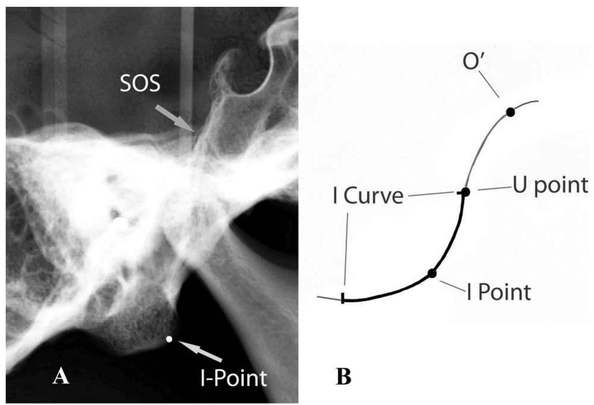I point: most anterior-inferior point on the condyle; u