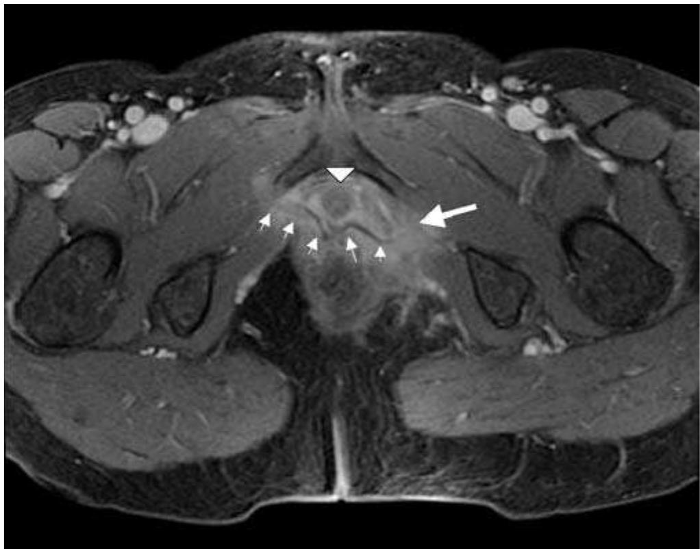 Coronal mri images of the pelvis. small arrows show path of