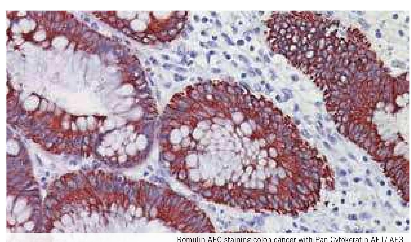 Bajoran purple staining squamous cell carcinoma with ck5