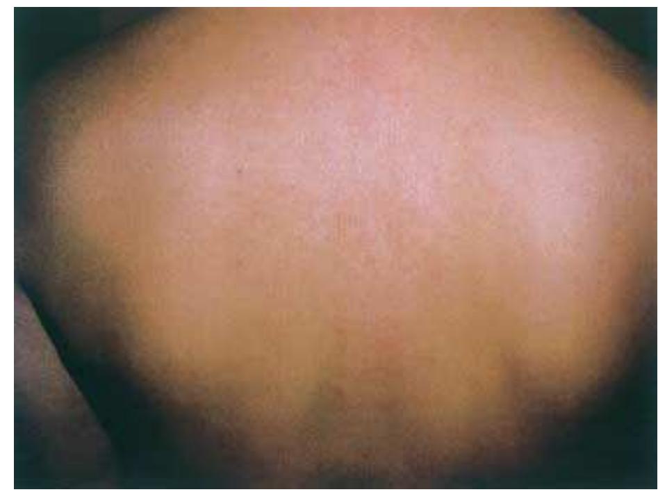 Persistent palpable reticular erythema of back.