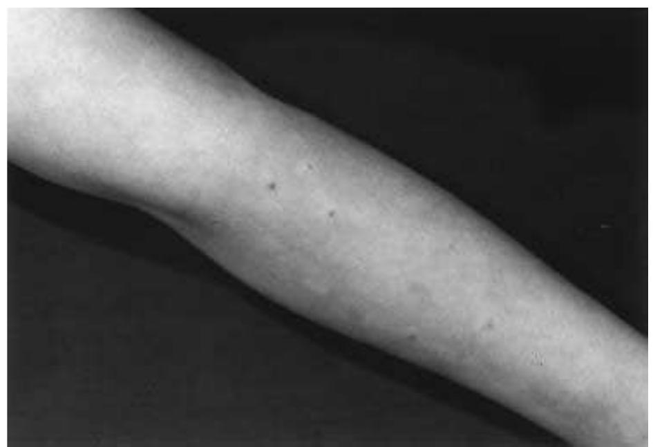 Multiple small papular, erythematous lesions on the arm,
