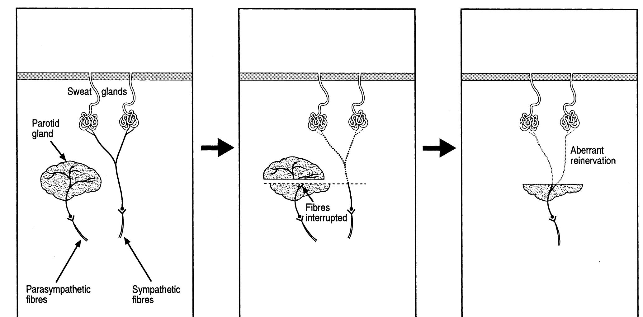 Pathophysiology of frey’s syndrome. (modified from sessions