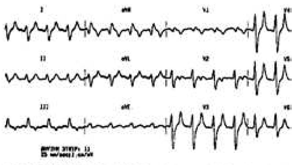 Figure 4 - Common errors in ECG diagnosis of coronary artery
