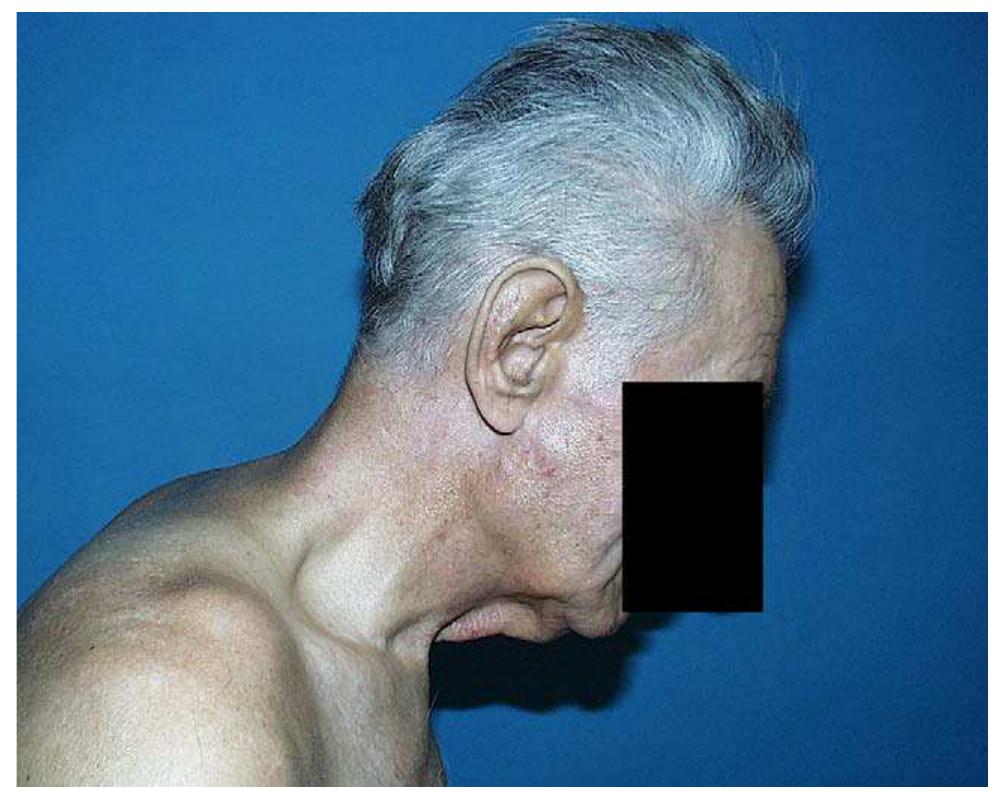 Severe kyphosis limits extension of the neck.