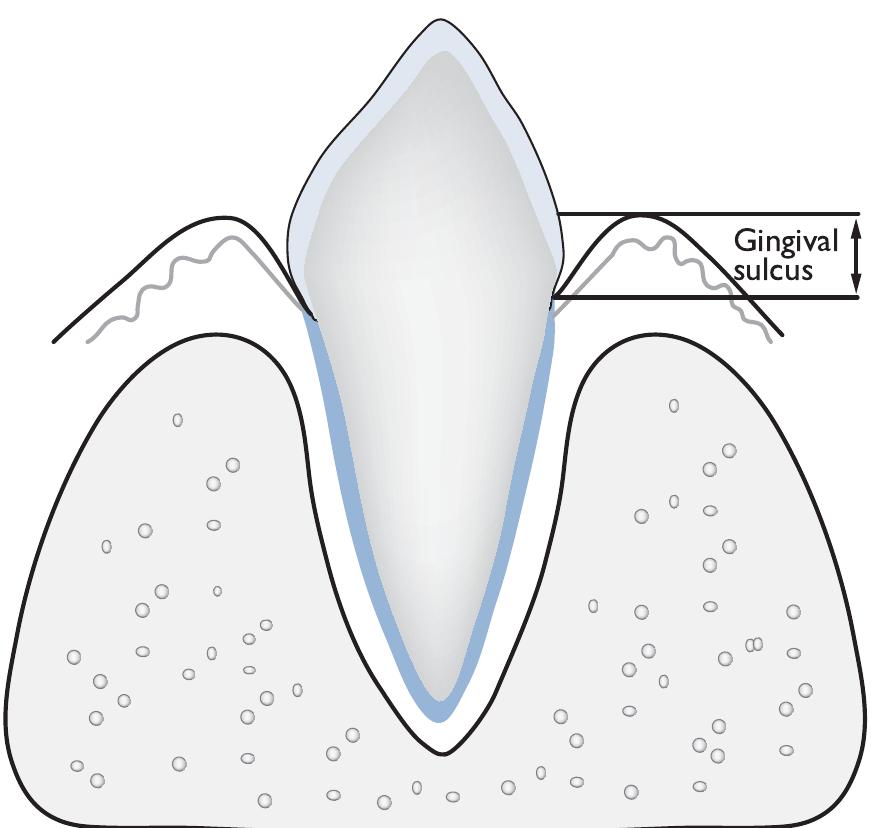 5 the gingival sulcus. the gingival sulcus is measured from