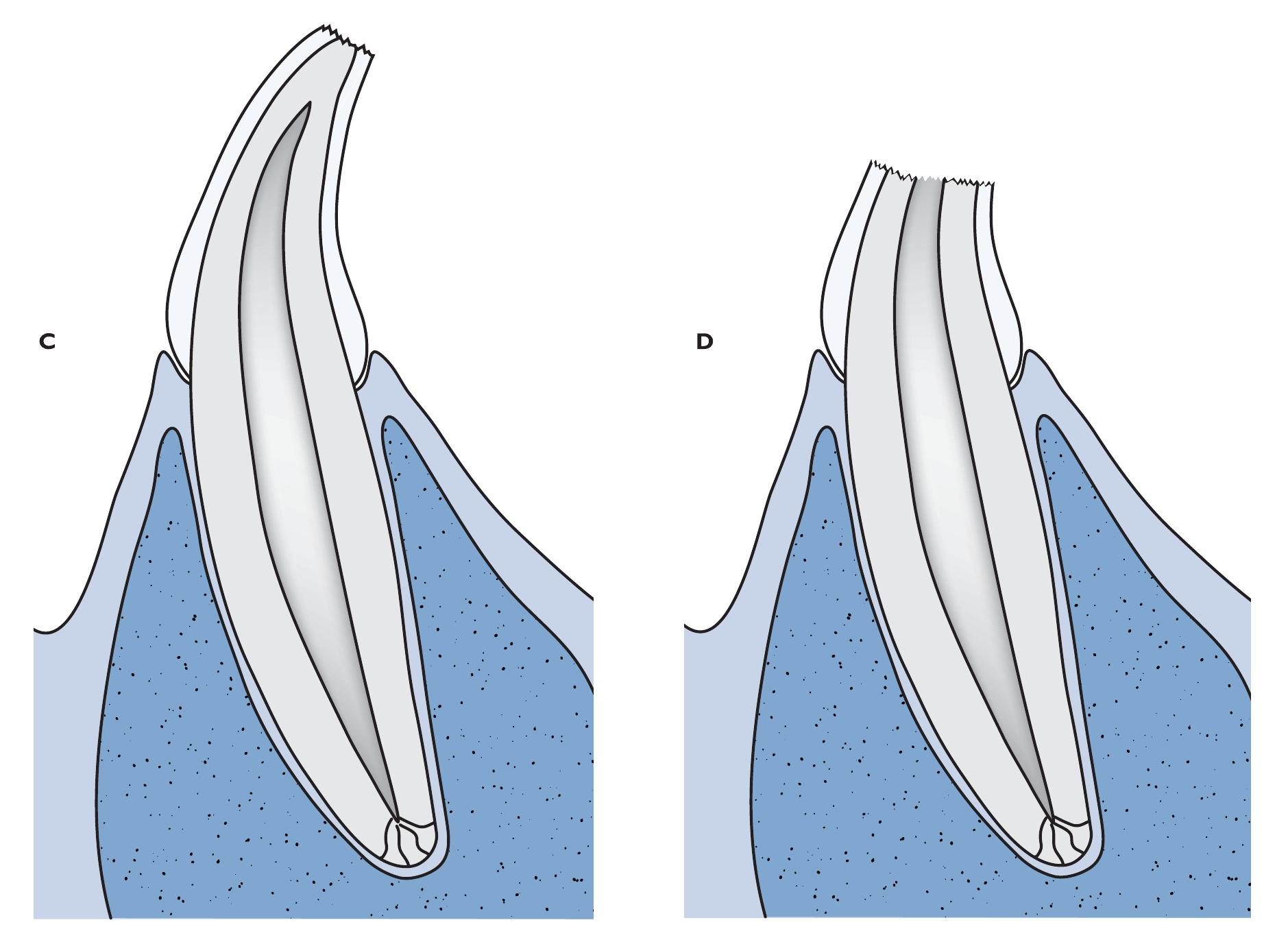 9 types of tooth crown injuries. (cont'd) c: uncomplicated