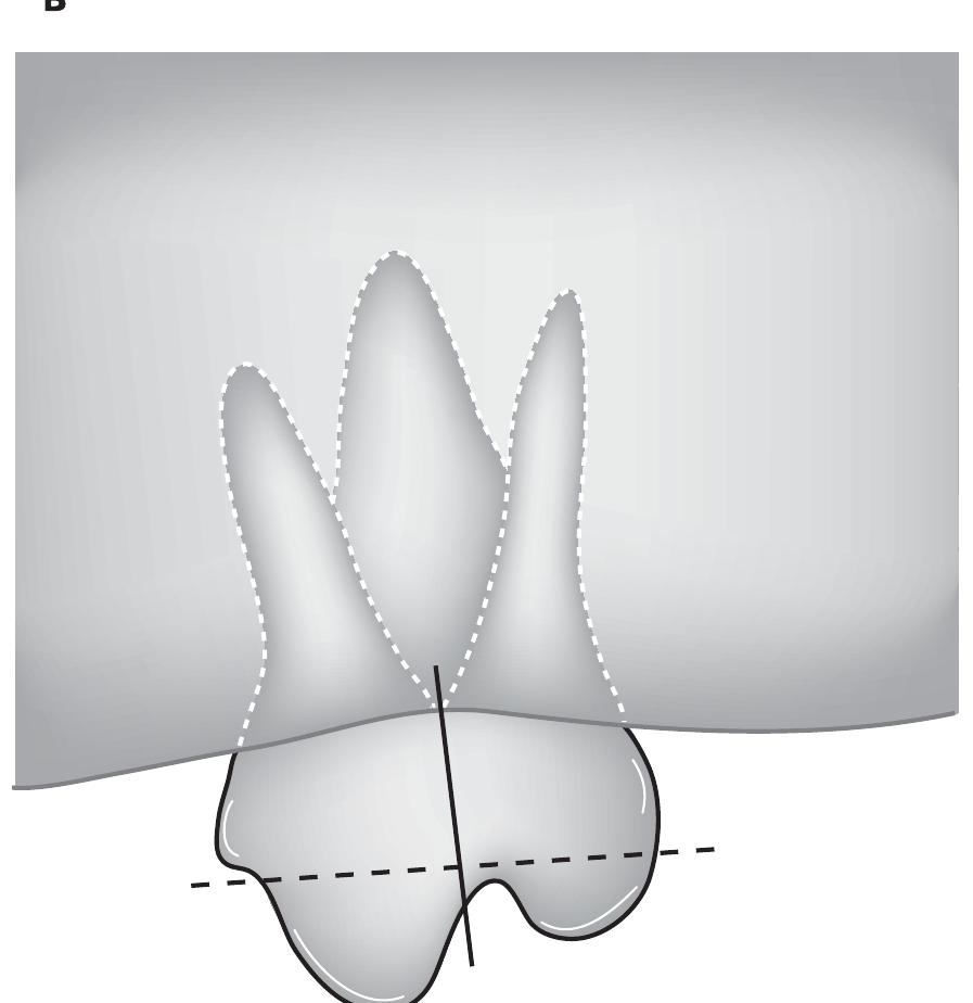 6 tooth sectioning — maxillary 1st molar. a: shorten the