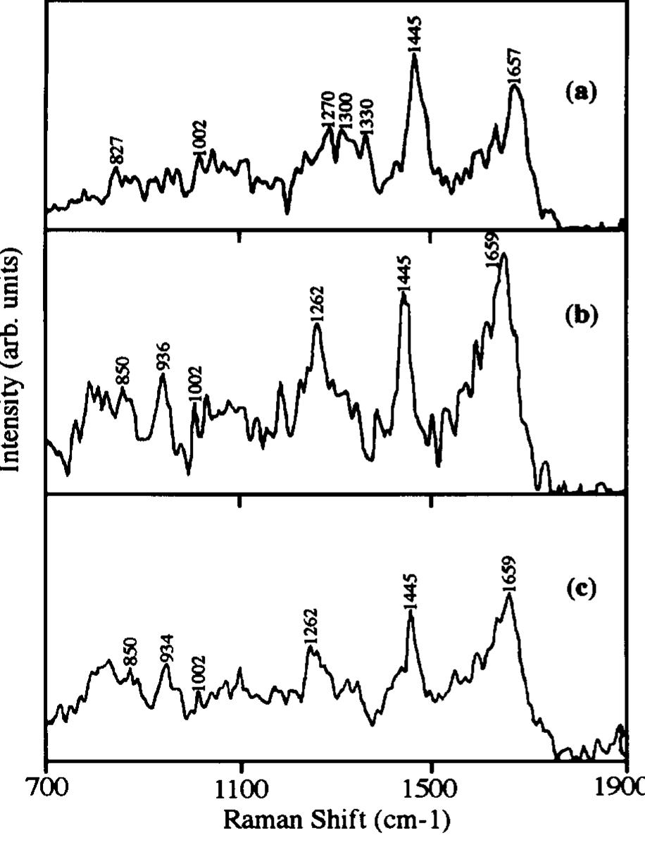 Ft raman spectra of (a) normal, (b) benign, and (c)
