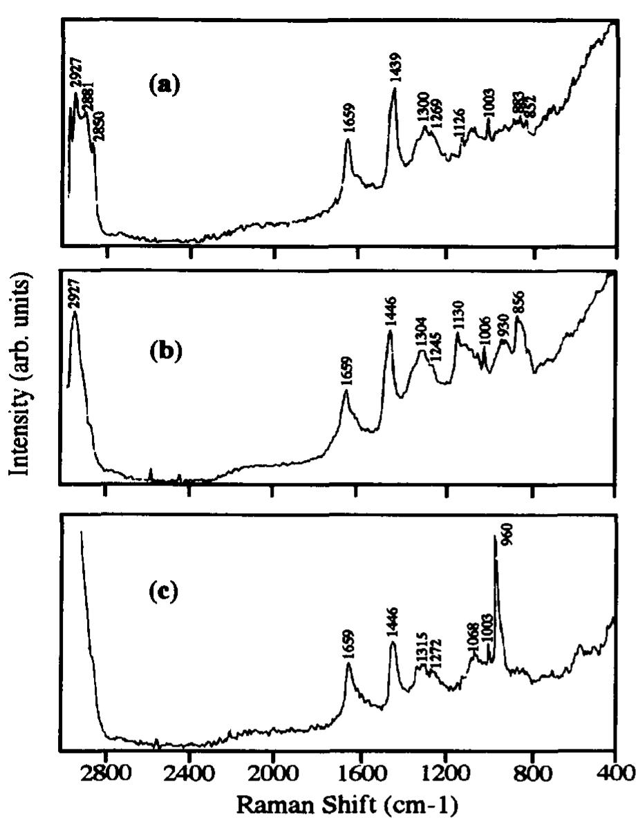 Ft raman spectra of (a) normal brain cortex, (b) glioma,