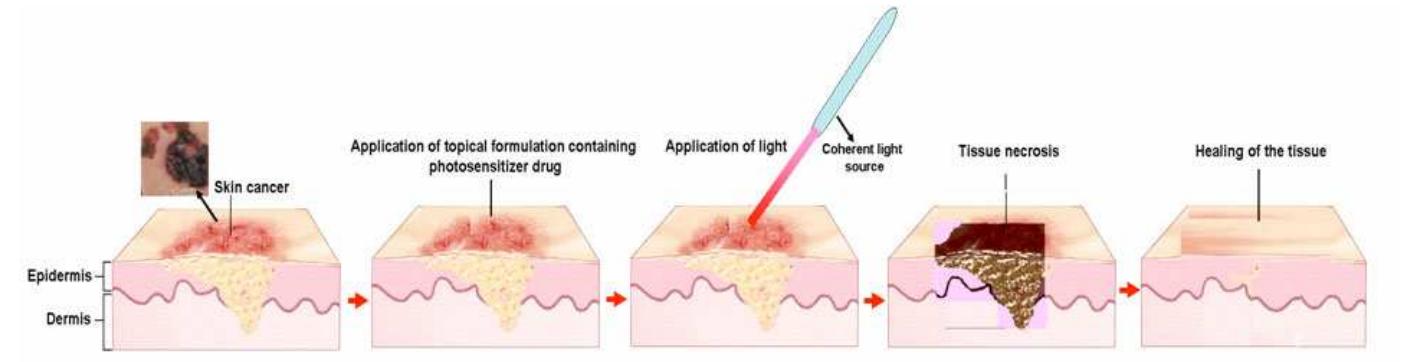 1 schematic representation of photodynamic therapy for skin