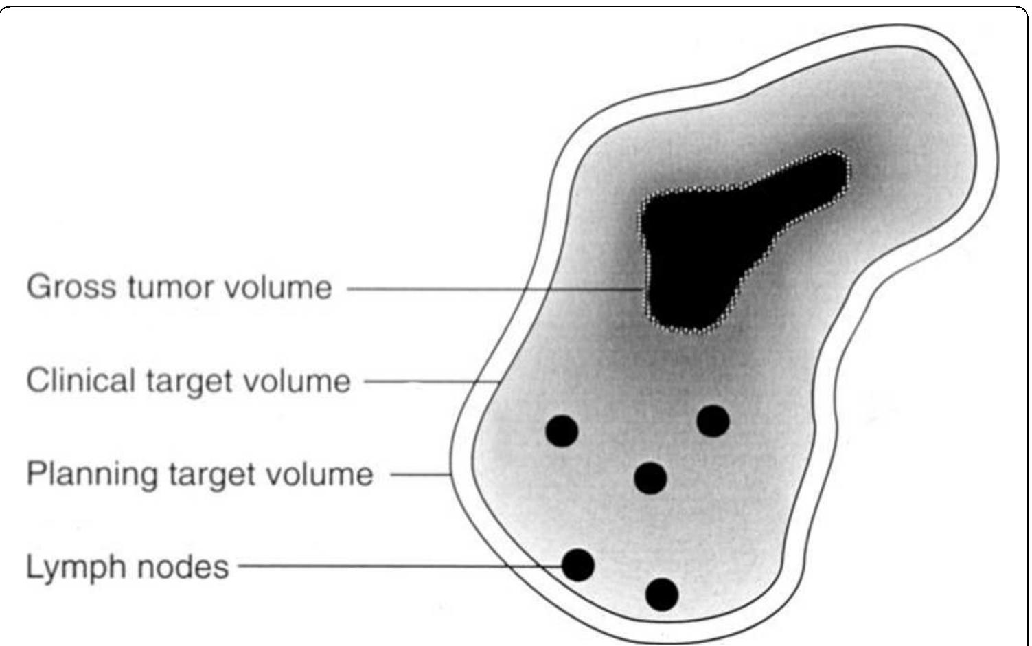 Illustration of target volumes. (courtesy of mary