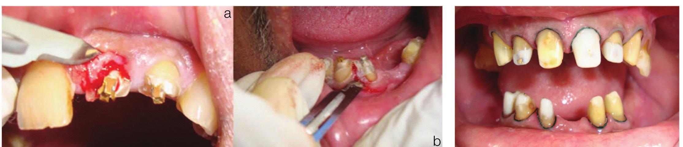 [table/fig-6]: maxillary and mandibular anterior teeth