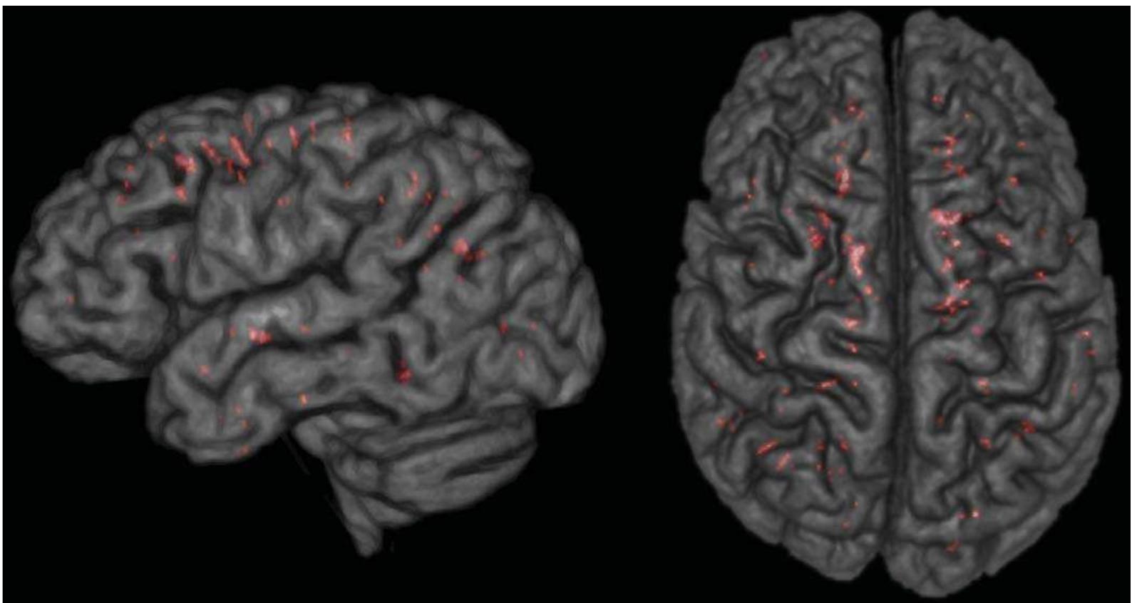 3d volume render showing total vrs segmentation (red) from a
