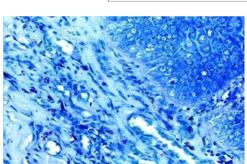 Oral epithelial dysplasia shows mast cells in the lamina