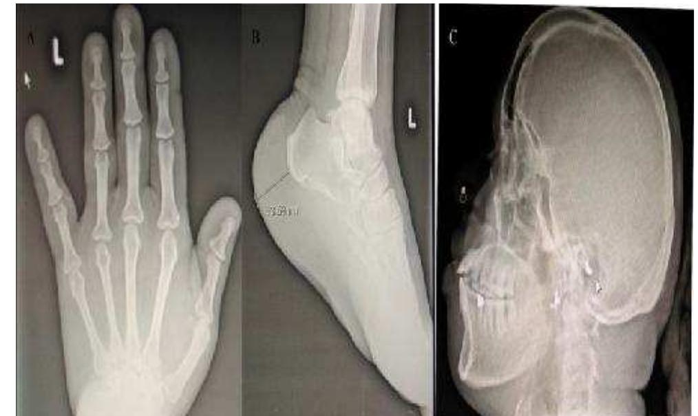 A: hand xray shows tufting of terminal phalanges arrow head