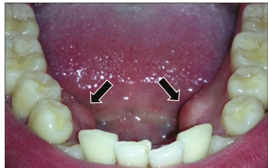 Figure 3 - from Prevalence of torus palatinus and torus