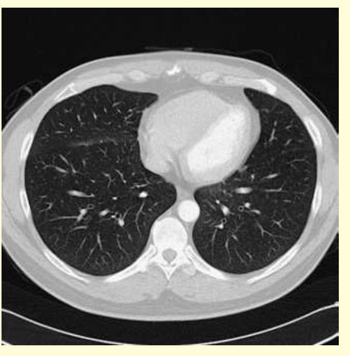 1 7a cross-sectional ct scans of the thorax at the level of