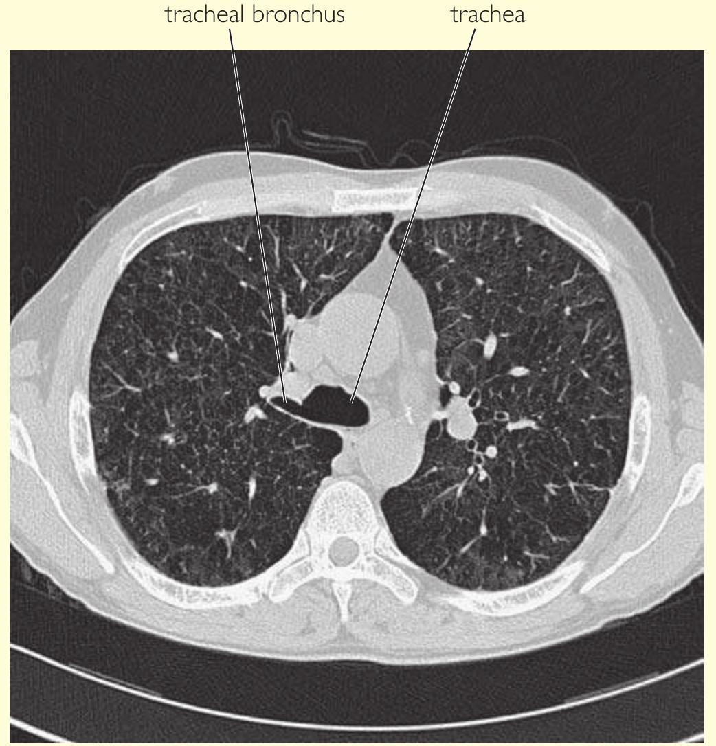 2j cross-sectional ct scan showing the tracheal bronchus