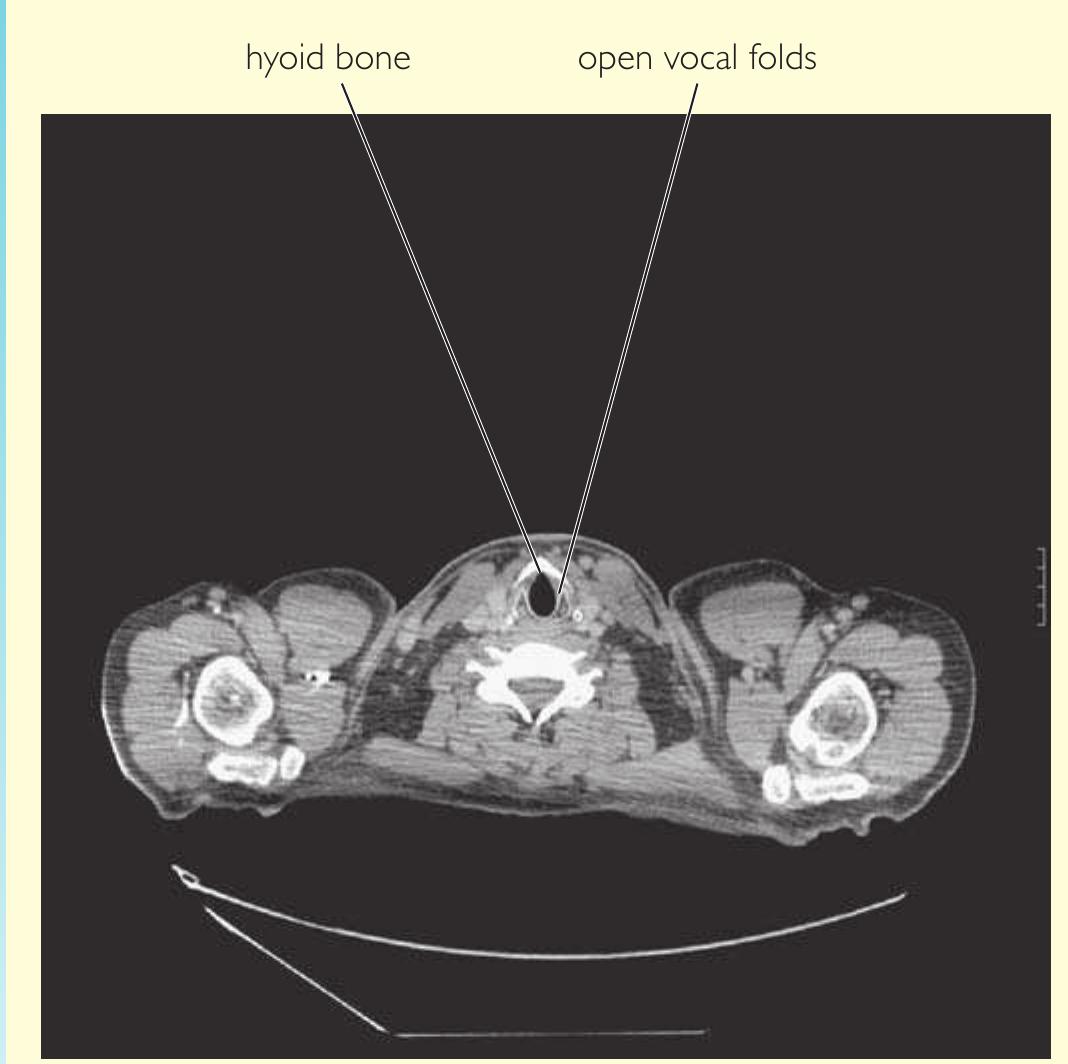 |e cross-sectional ct scan at the superior aspect of the