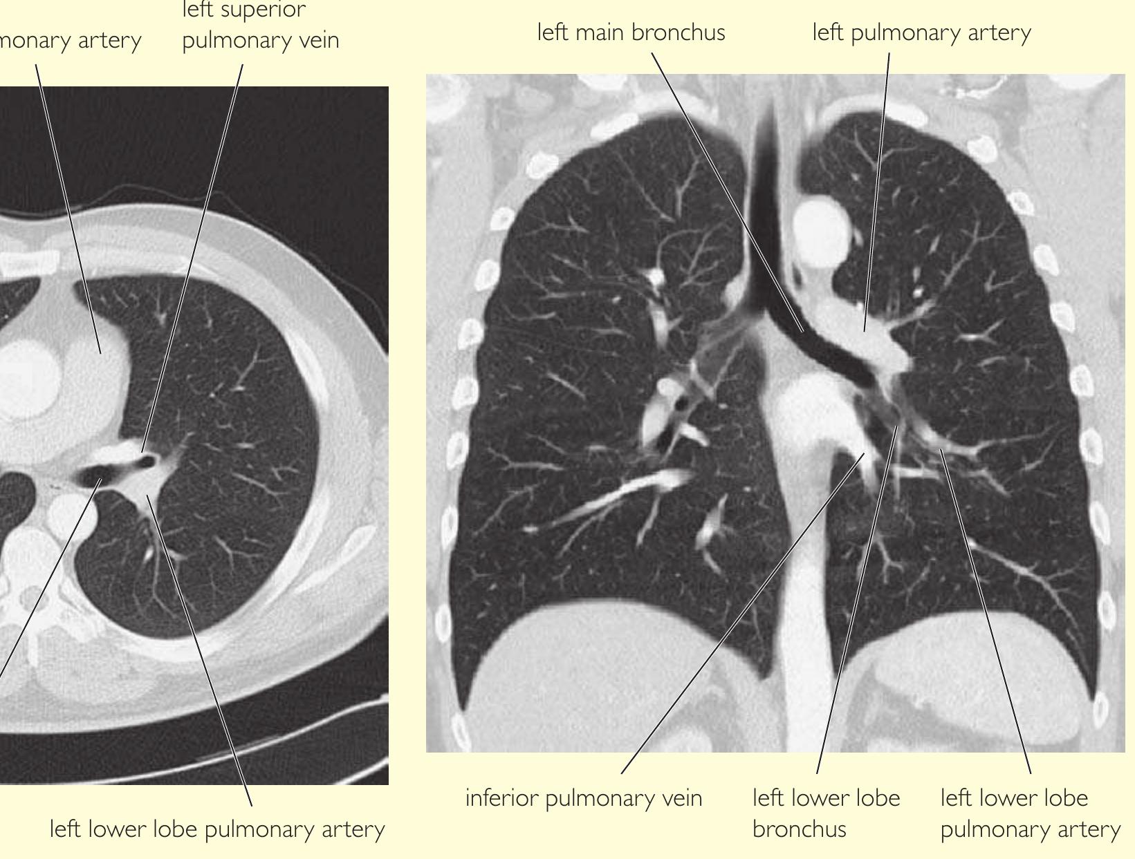 9b coronal sectional ct scan of the thorax at the level of