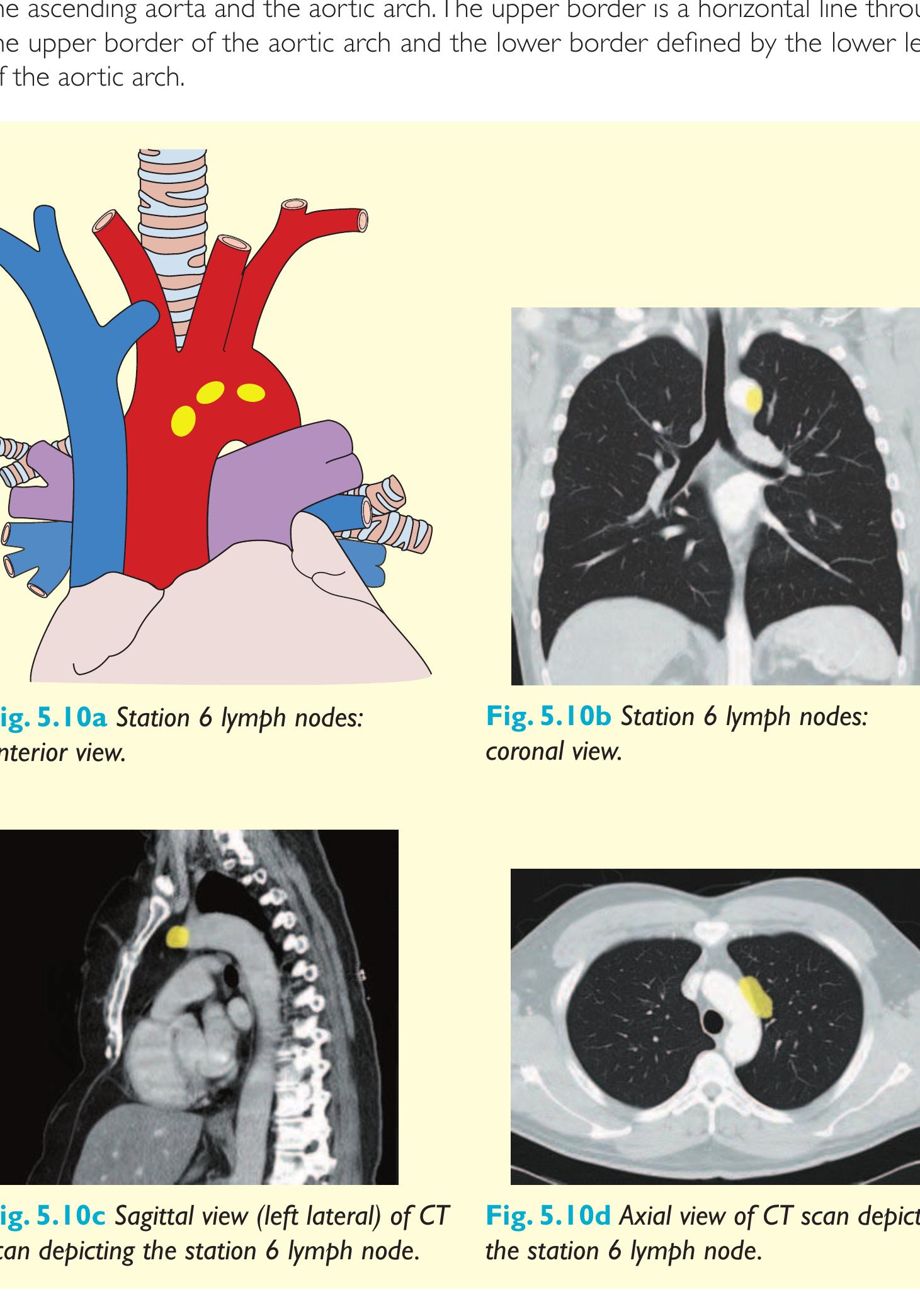 Station 6: para-aortic lymph nodes (fig.