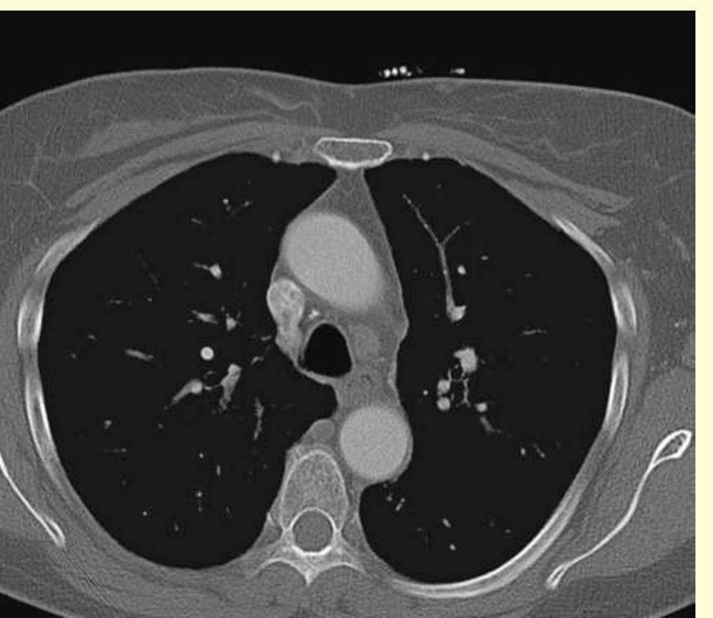 5a Cross Sectional Ct Scan Of The Thorax Showing A