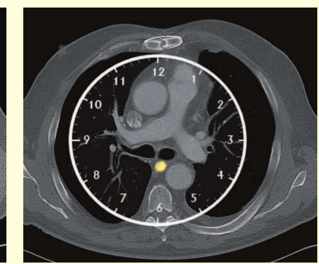 6b cross-sectional ct scan with a superimposed clock face