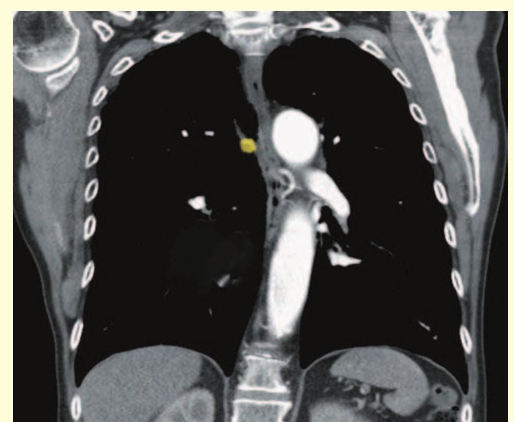 6d coronal section of ct scan showing the vertical position