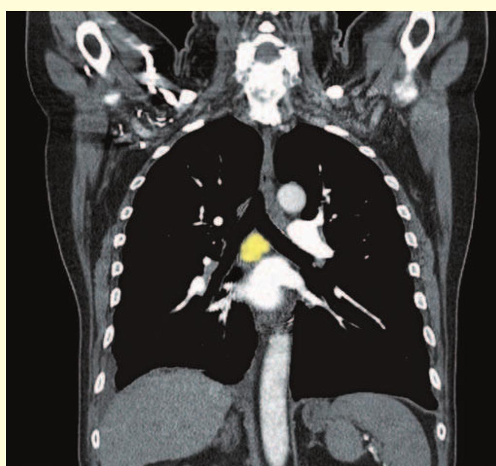 7d coronal section of ct scan showing the vertical position