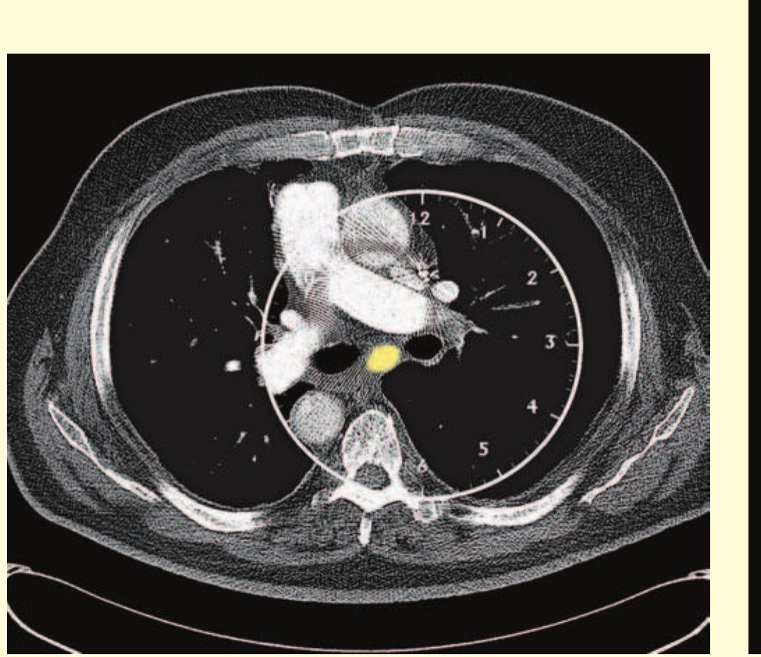 7 Cross Sectional Ct Scan Of The Thorax Flipped On The