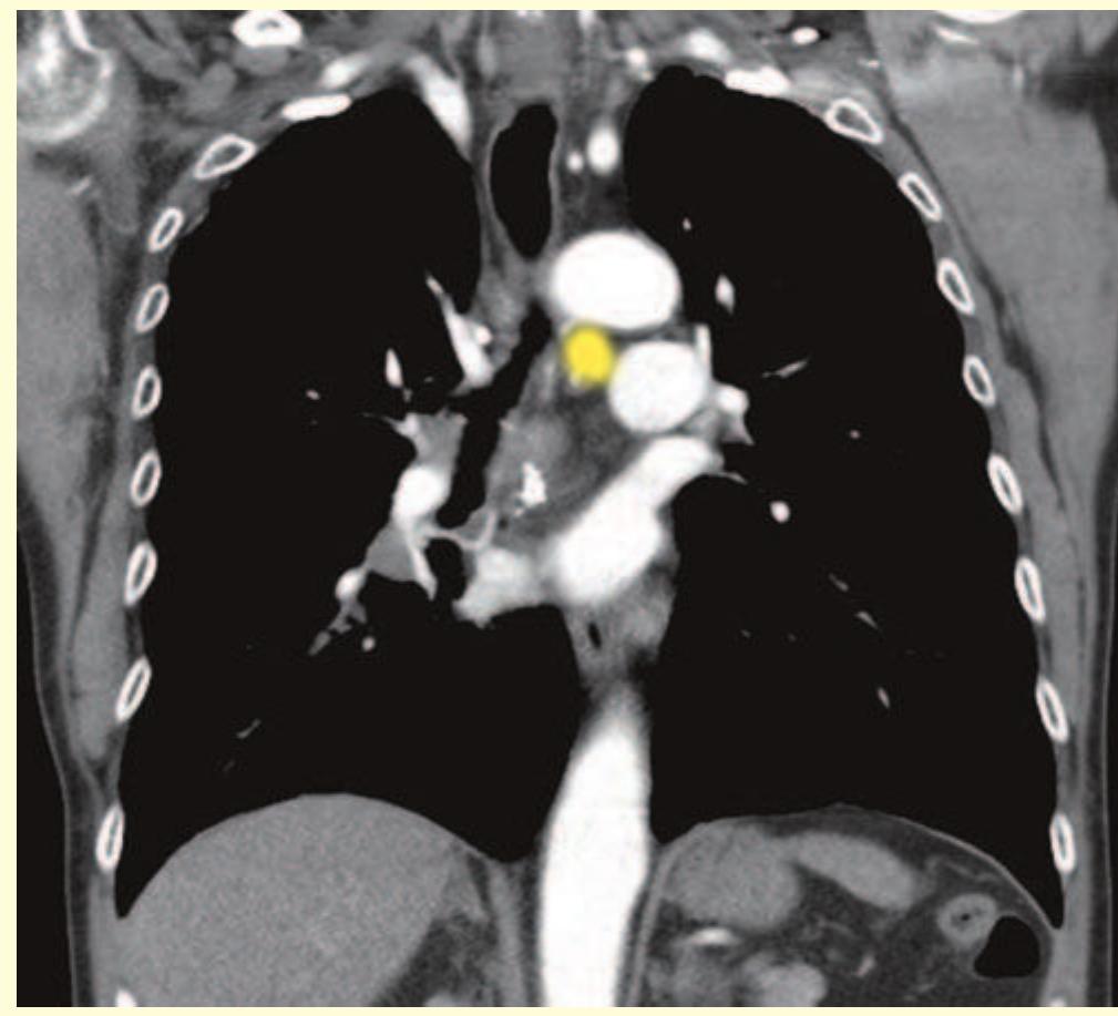 9d coronal section of ct scan showing the vertical position