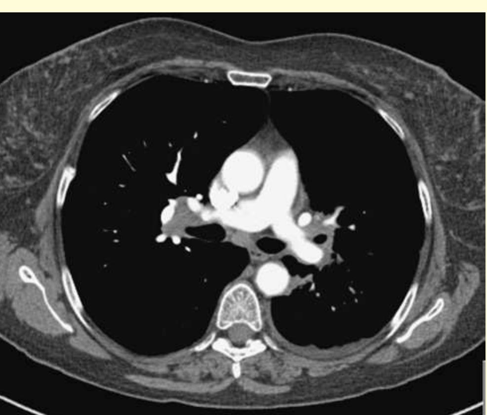 10a Cross Sectional Ct Scan Of The Thorax Showing A Station