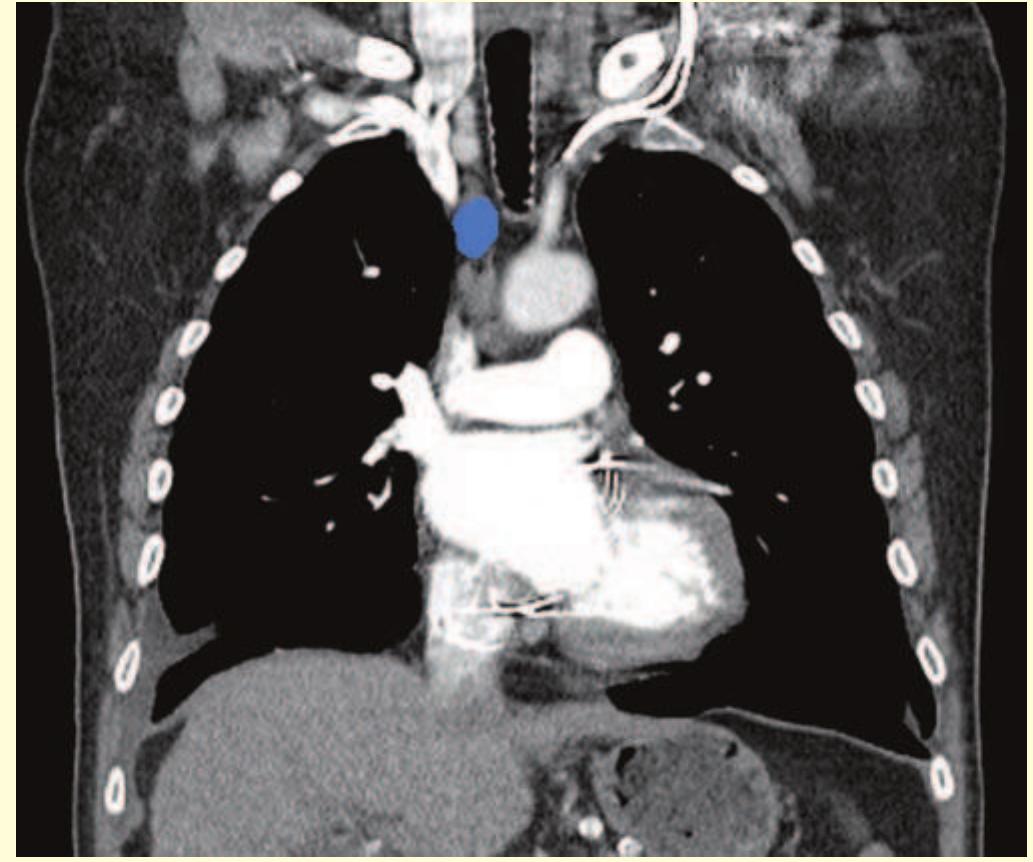 4c coronal section of ct scan showing the 2r lymph node.