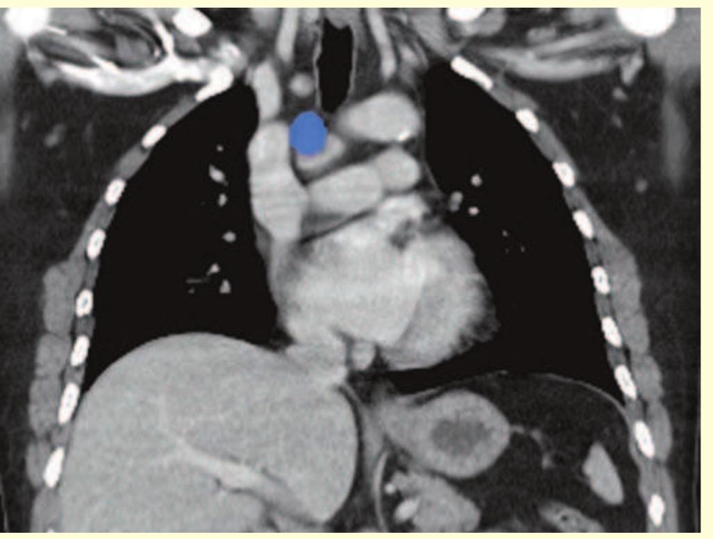 13c coronal section of ct scan showing the |0r lymph node.
