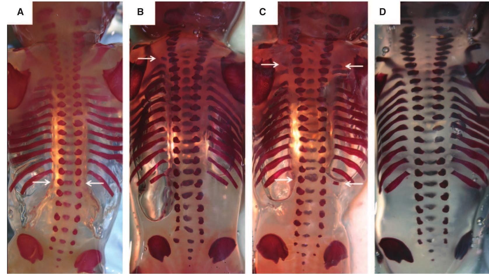 Examples of the observed rib anomalies (indicated by
