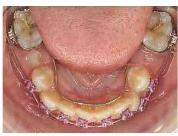 (PDF) Transpalatal, Nance and Lingual Arch Appliances (3)