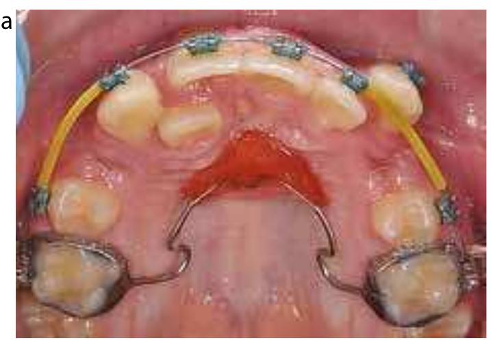 (PDF) Transpalatal, Nance and Lingual Arch Appliances (3)