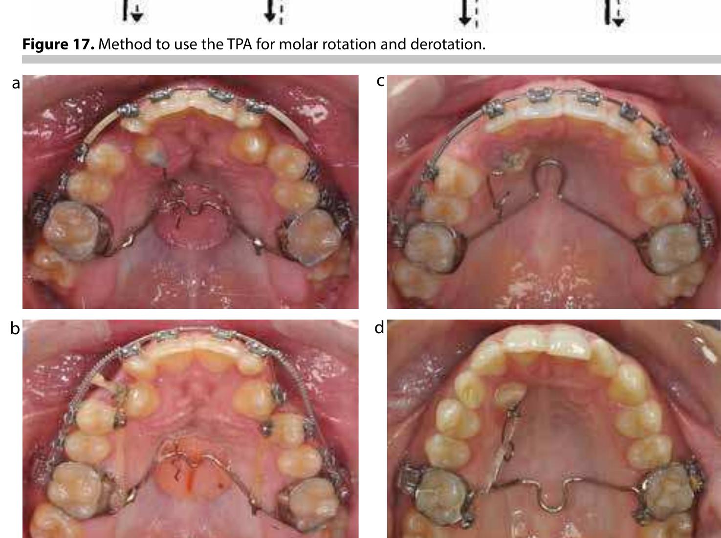 (PDF) Transpalatal, Nance and Lingual Arch Appliances (3)