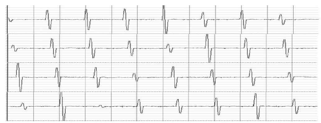 Interleaved biphasic electrical pulses of the first four