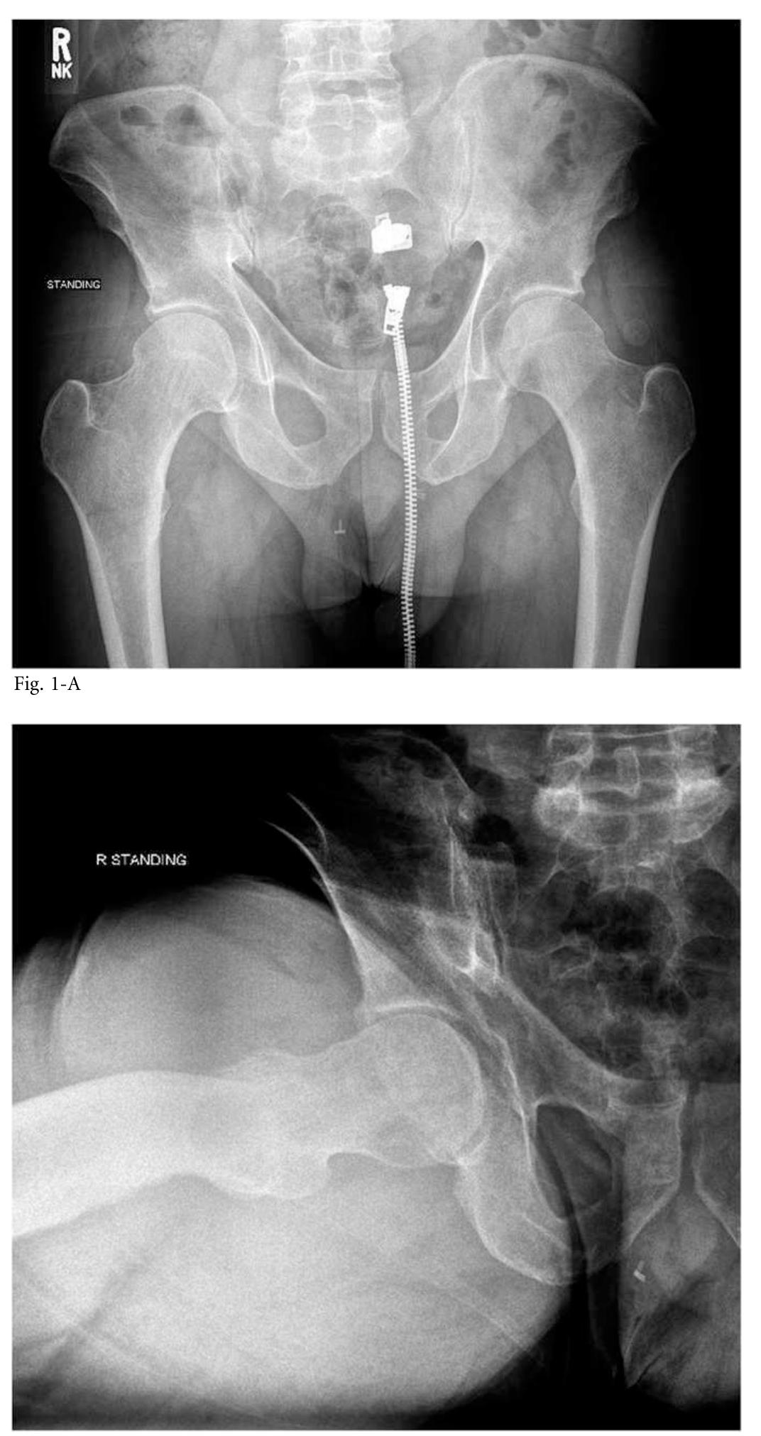Initial anteroposterior pelvic (fig. 1-a) and right hip