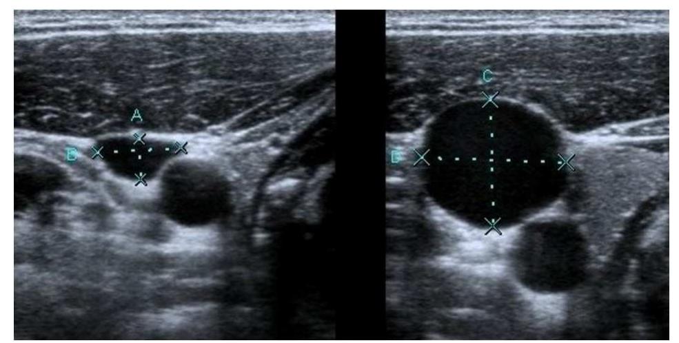 Sonographic measurement of ijv ap and t diameters at rest
